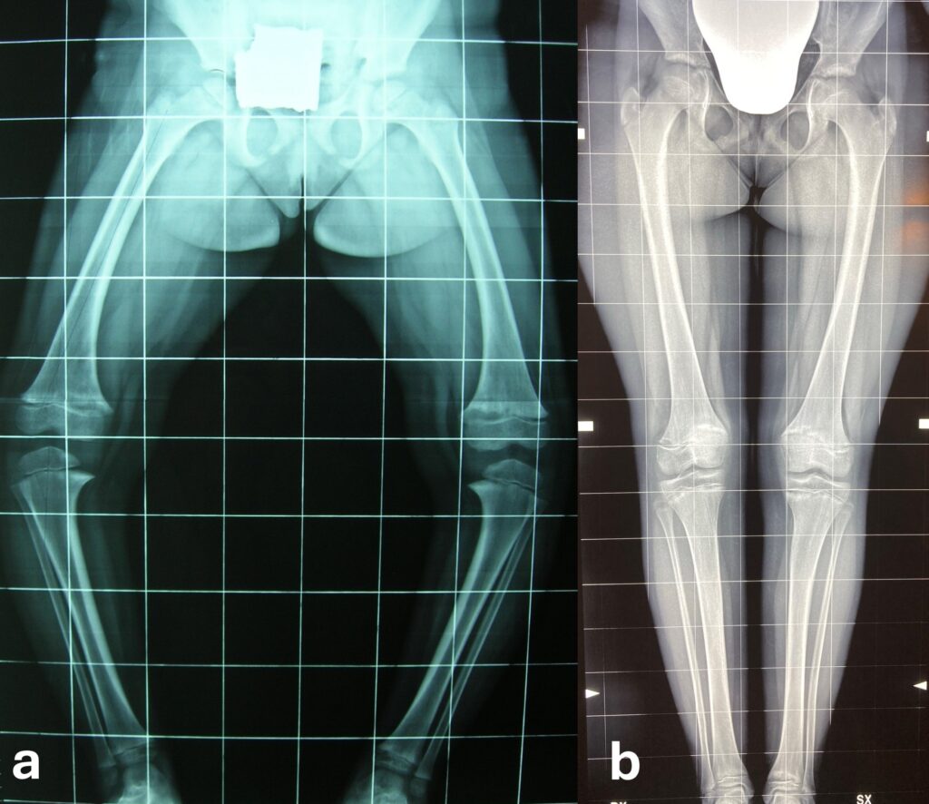 Varus knees (genu varum) with internal rotation in a syndrome ...