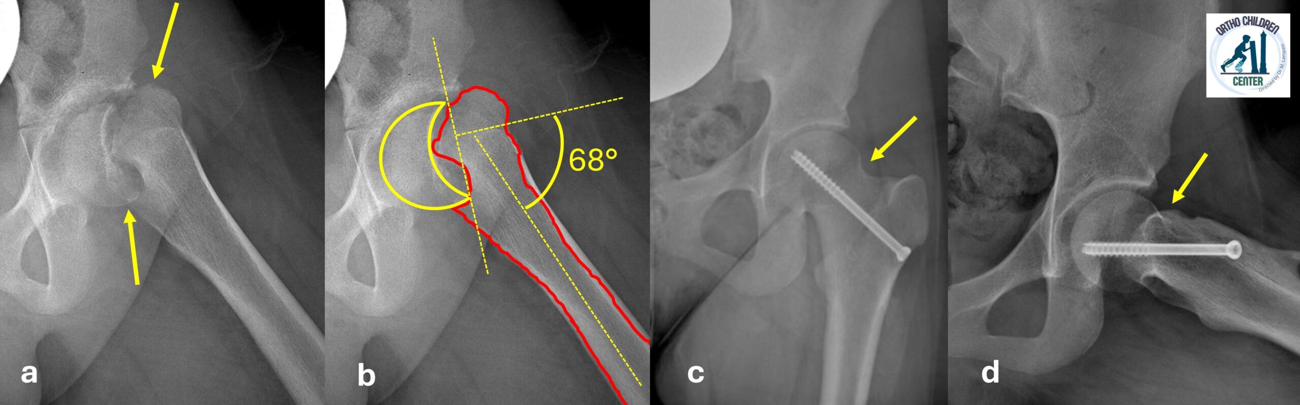Acute Slipped Capital Femoral Epiphysis: reduction and synthesis ...