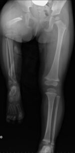 Congenital Femoral Deficiency (CFD): treatment | Ortho Children Center ...