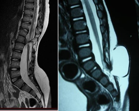 Tethered spinal cord syndrome: orthopedic treatment | Ortho Children ...