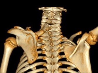 Scapola alta congenita: diagnosi e trattamento chirurgico | Ortho ...