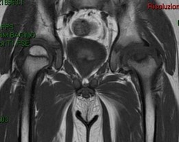 Perthes disease: symptoms and treatment | Ortho Children Center | Bologna