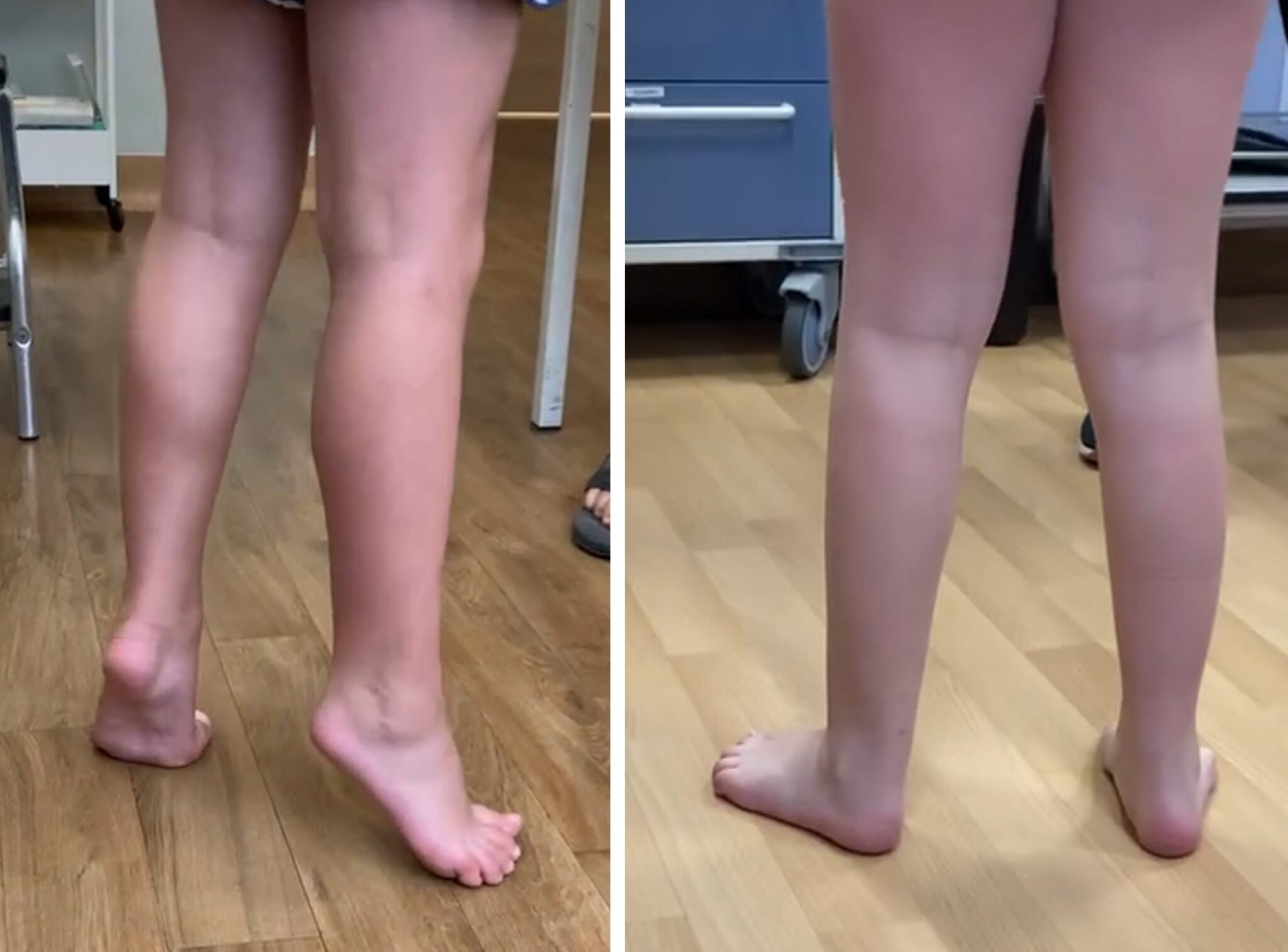 Toe walking | Ortho Children Center