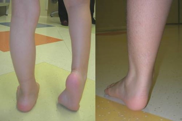 Piede equino: definizione e trattamento ortopedico | Ortho Children ...