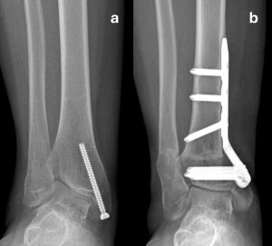 Ankle: acquired deformities | OrthoChildren Center | Bologna