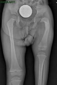 Proximal Femoral Focal Deficiency: treatment | Ortho Children Center ...