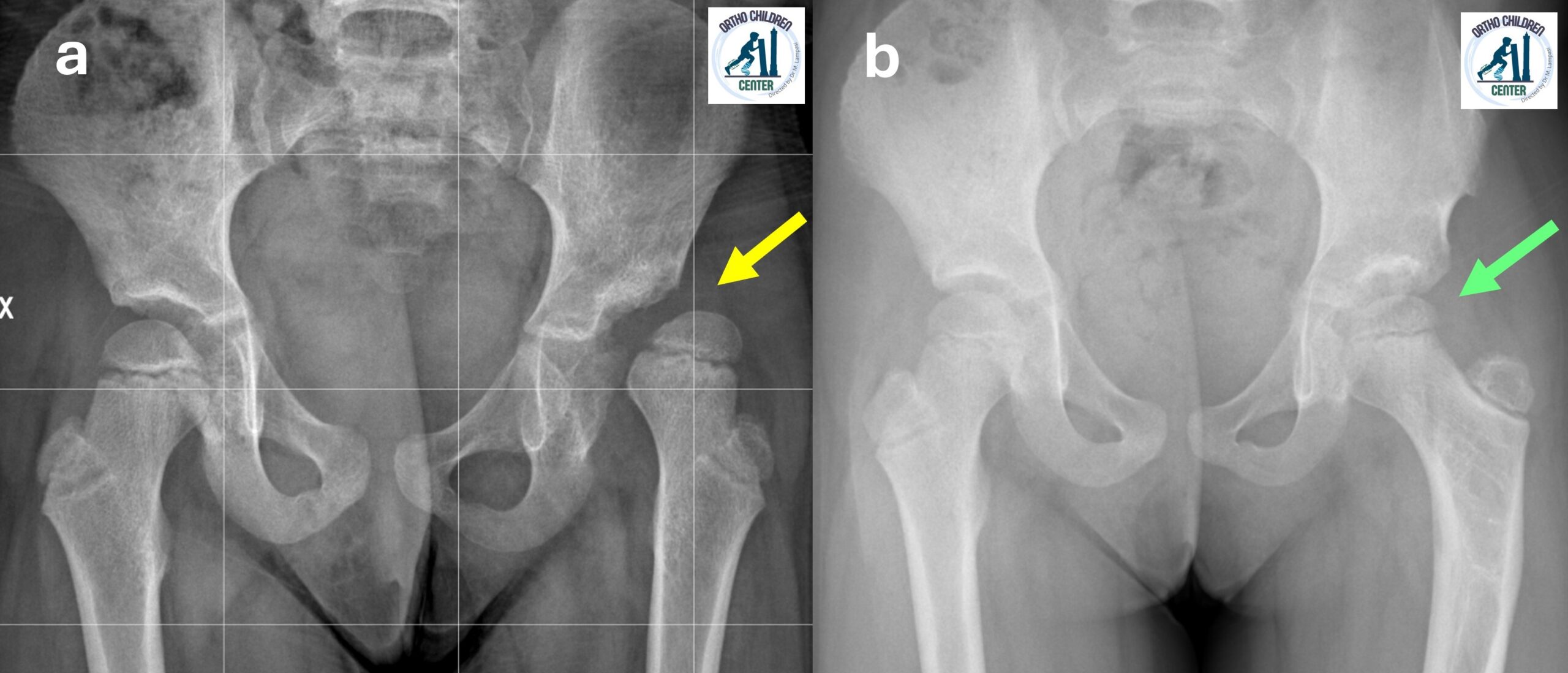 Congenital hip dislocation (DDH): femoral and pelvic osteotomy ...