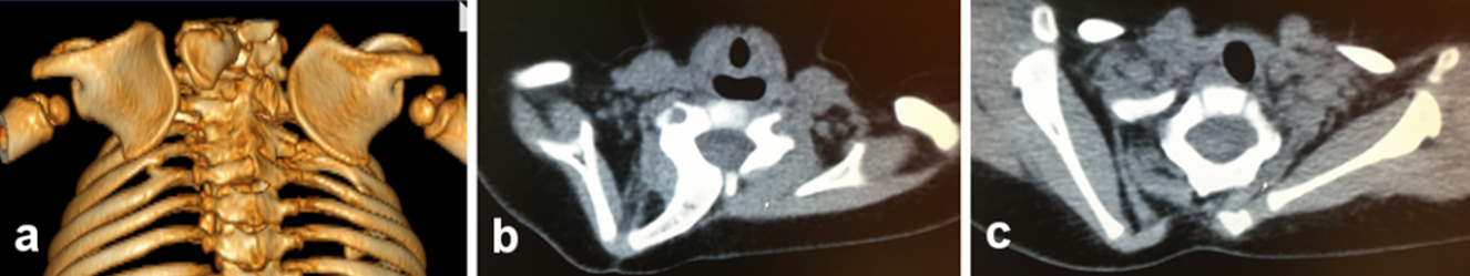 Scapola alta congenita: diagnosi e trattamento chirurgico | Ortho ...