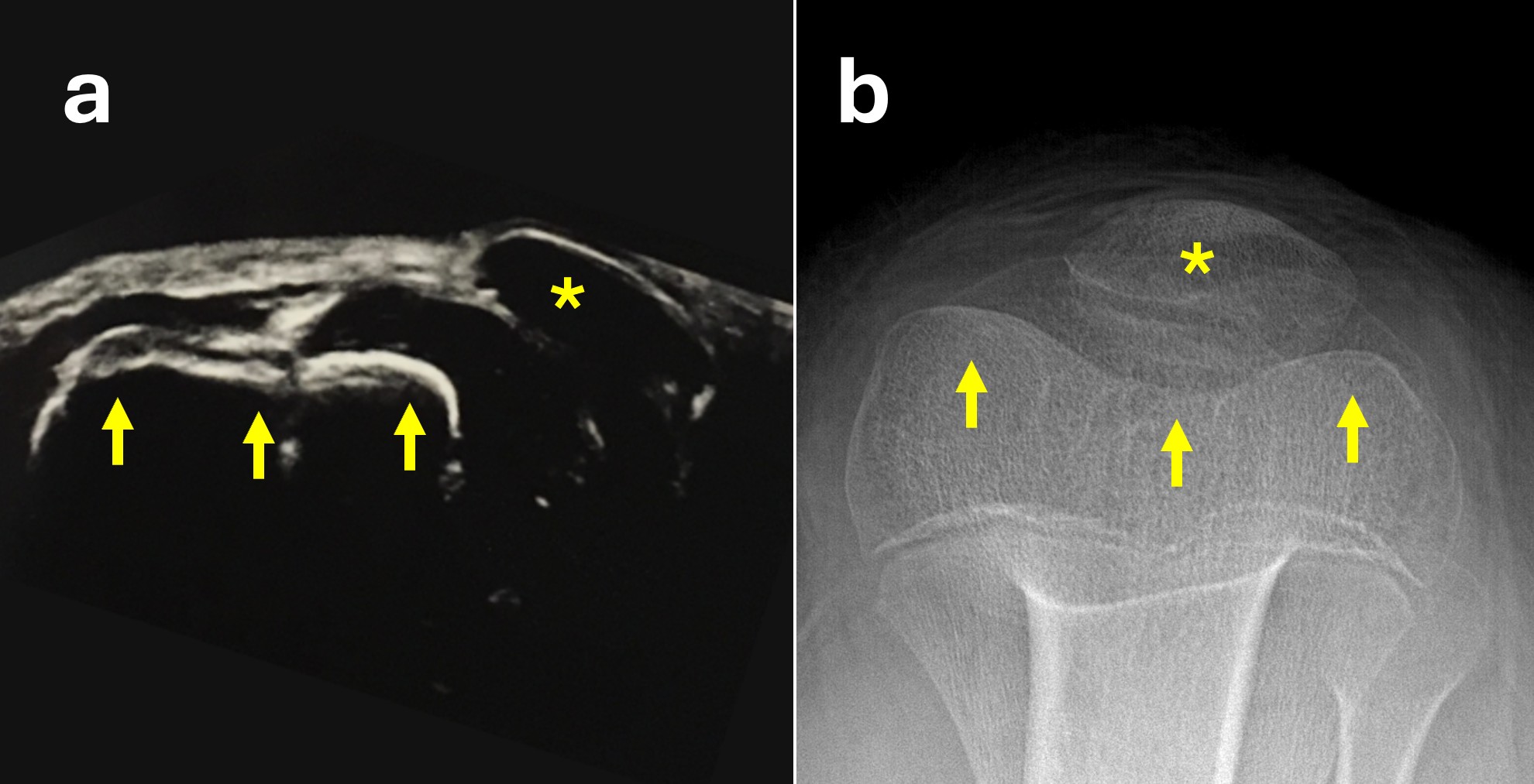 Lussazione congenita della rotula: diagnosi e trattamento | Ortho ...