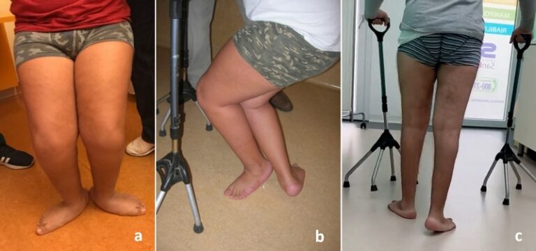 Treatment of crouch gait in cerebral palsy | Techniques of excellence ...