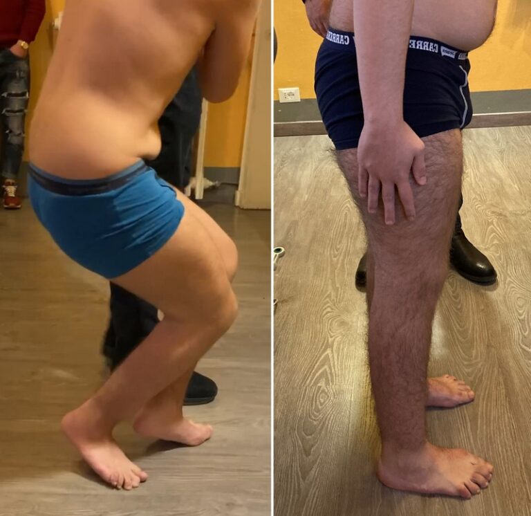 Trattamento del cammino con ginocchia flesse (crouch gait) nella ...